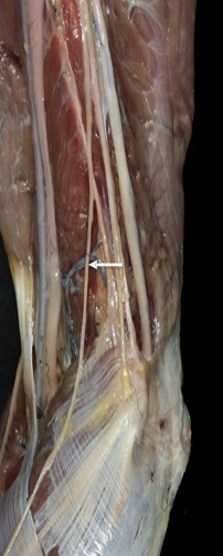 Medial Antebrachial Cutaneous Nerve (MABCN) - Martinoli Ultrasound