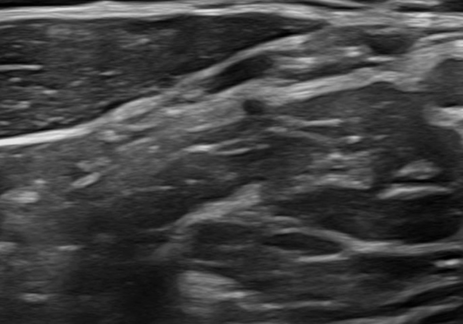 Phrenic - Martinoli Ultrasound