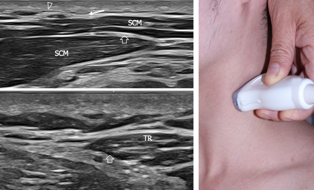 Spinal Accessory (CN XI) - Martinoli Ultrasound