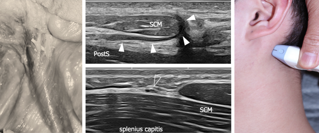 Lesser Occipital - Martinoli Ultrasound