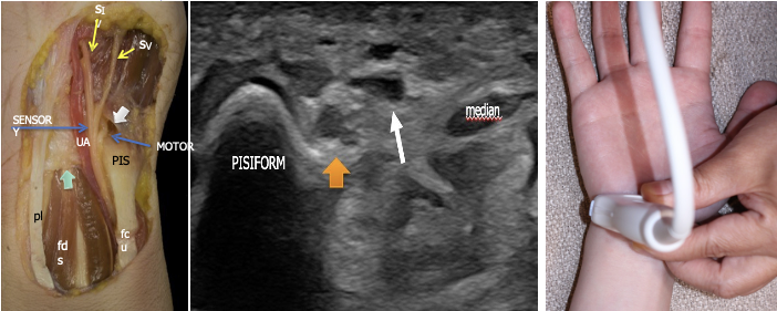 Ulnar Nerve Guyon's Canal - Martinoli Ultrasound